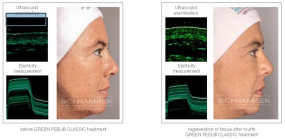 The Green Peel - Trillium Laser Anti-Aging Clinic